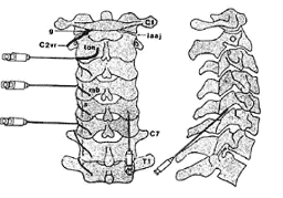 Facet Joint Blocks - PMCOA