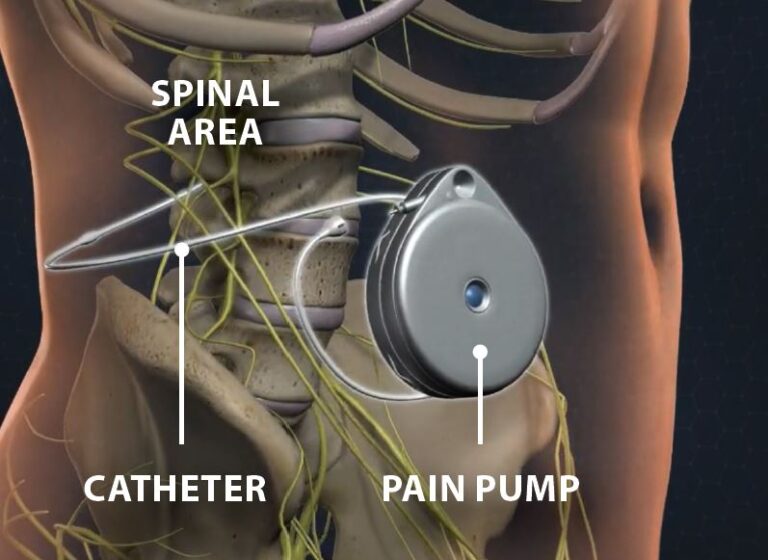 What is a Pain Pump - PMCOA