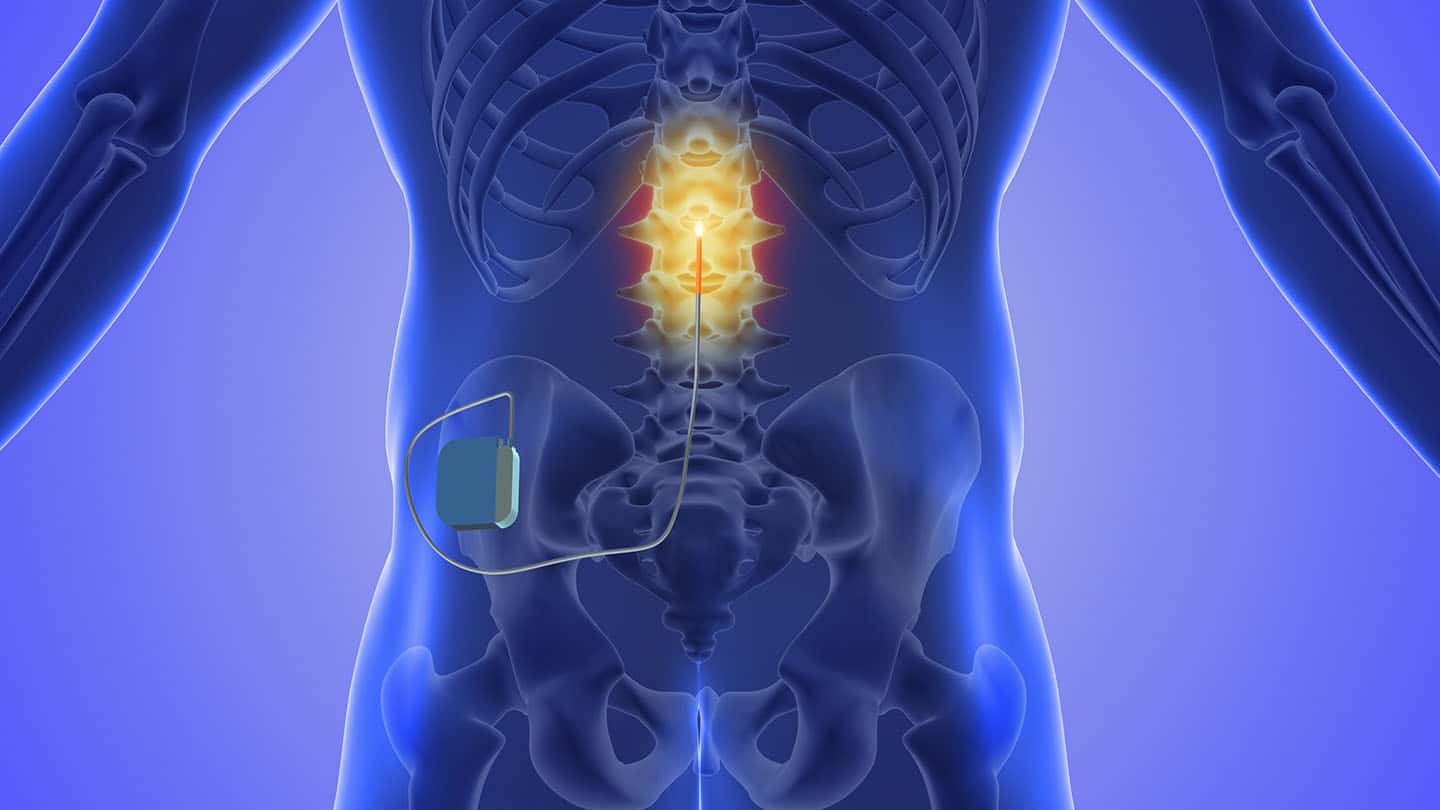 What is Spinal Cord Stimulation - PMCOA